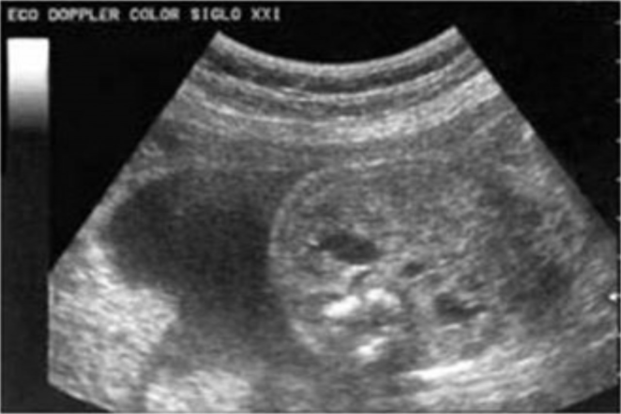 Hidronefrosis fetal. Reporte de un caso y revisión bibliográfica Caso ...