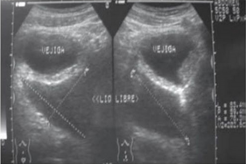 Ruptura esplénica espontanea secundaria a amiloidosis - Diplomadomedico.com