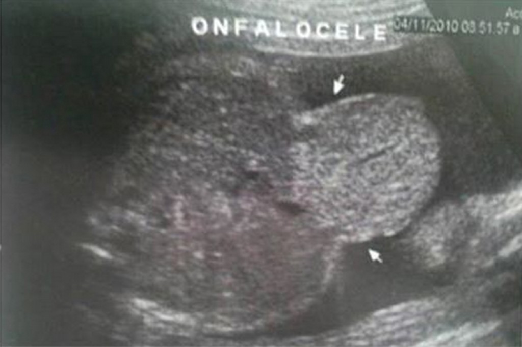 Onfalocele fetal exposición de caso clínico y revisión ...