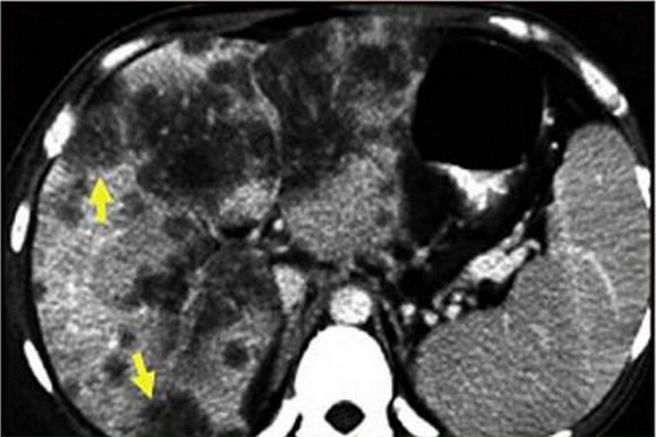 Carcinoma hepatocelular: diagnostico, estatificación y estrategia ...