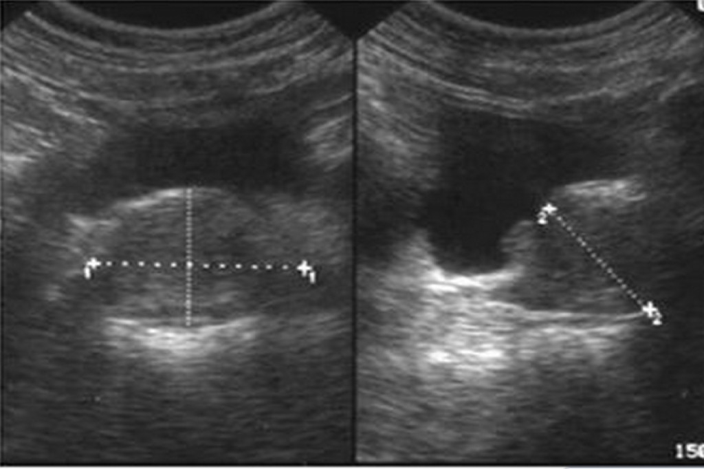 Patologías benignas de la próstata: prostatitis e hiperplasia benigna ...