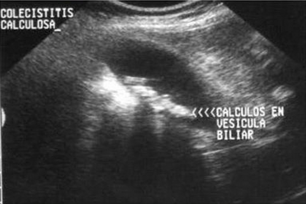Imagen en Litiasis Vesicular (Colelitiasis) - Diplomadomedico.com