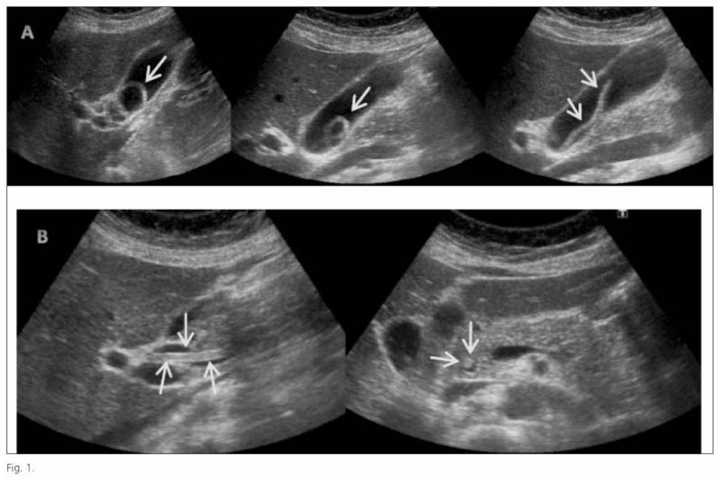 Un nuevo caso de una rara anomalía de las vías biliares ...