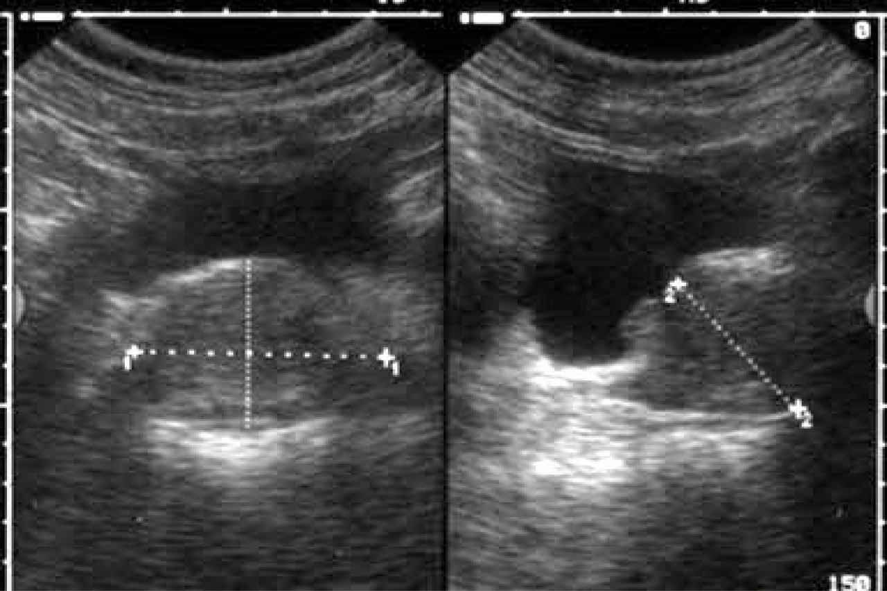 Diagnóstico de cáncer de próstata con biopsia guiada por ultrasonido ...