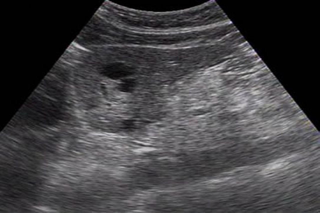 MANEJO QUIRURGICO DE LOS QUISTES HEPATICOS SIMPLES - Diplomadomedico.com