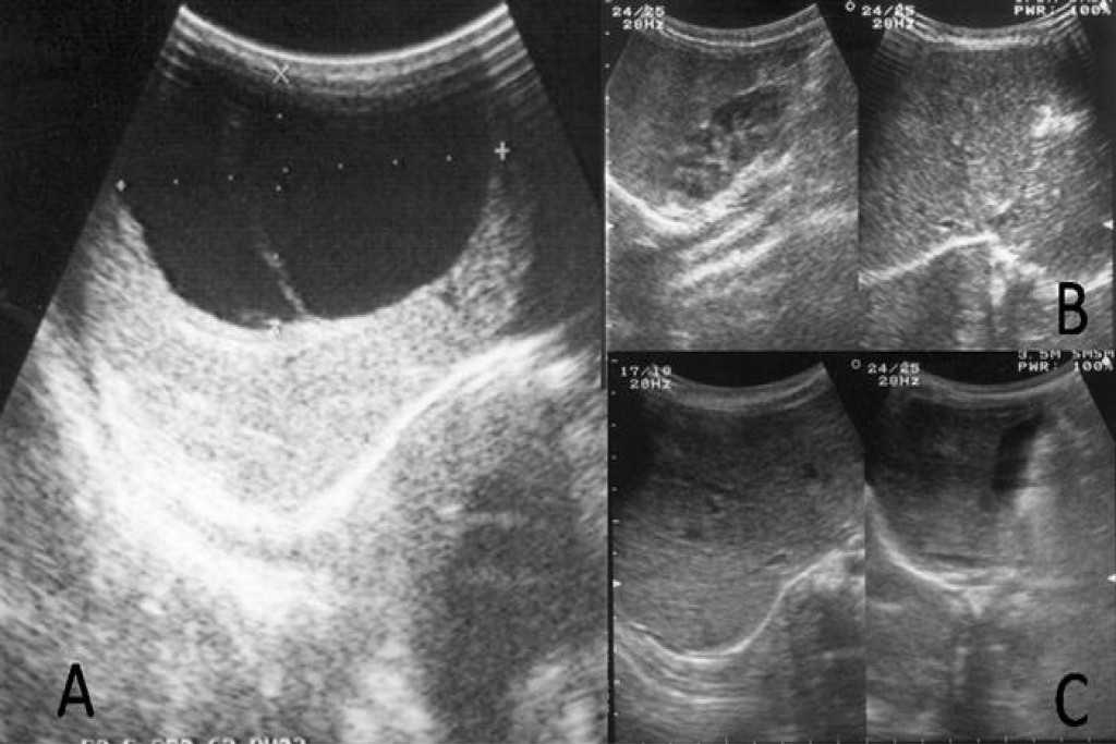 QUISTE DE COLEDOCO DETECTADO PRENATALMENTE