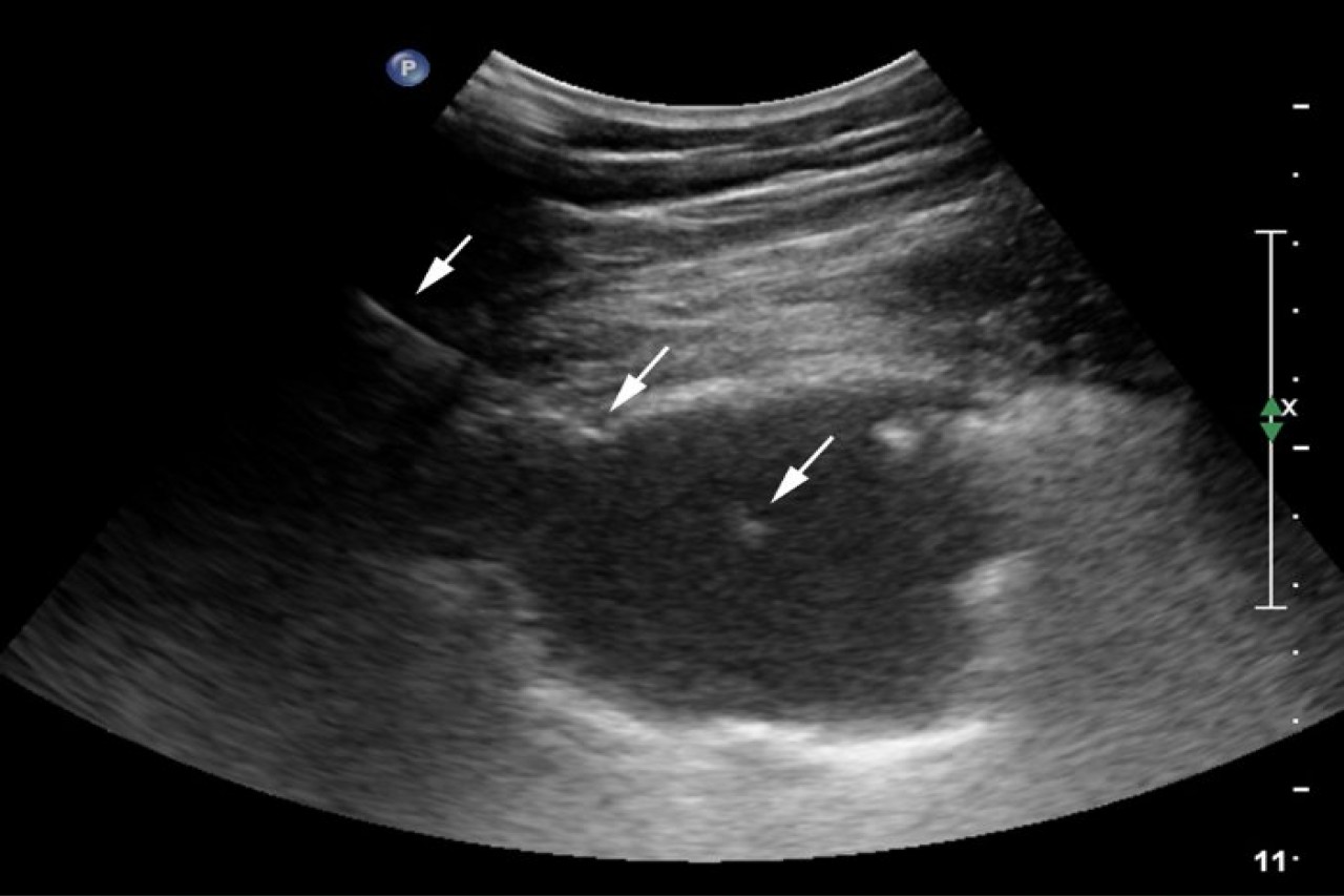 DETECCIÓN DE CÁNCER DE PRÓSTATA MEDIANTE BIOPSIA GUIADA POR ULTRASONIDO ...