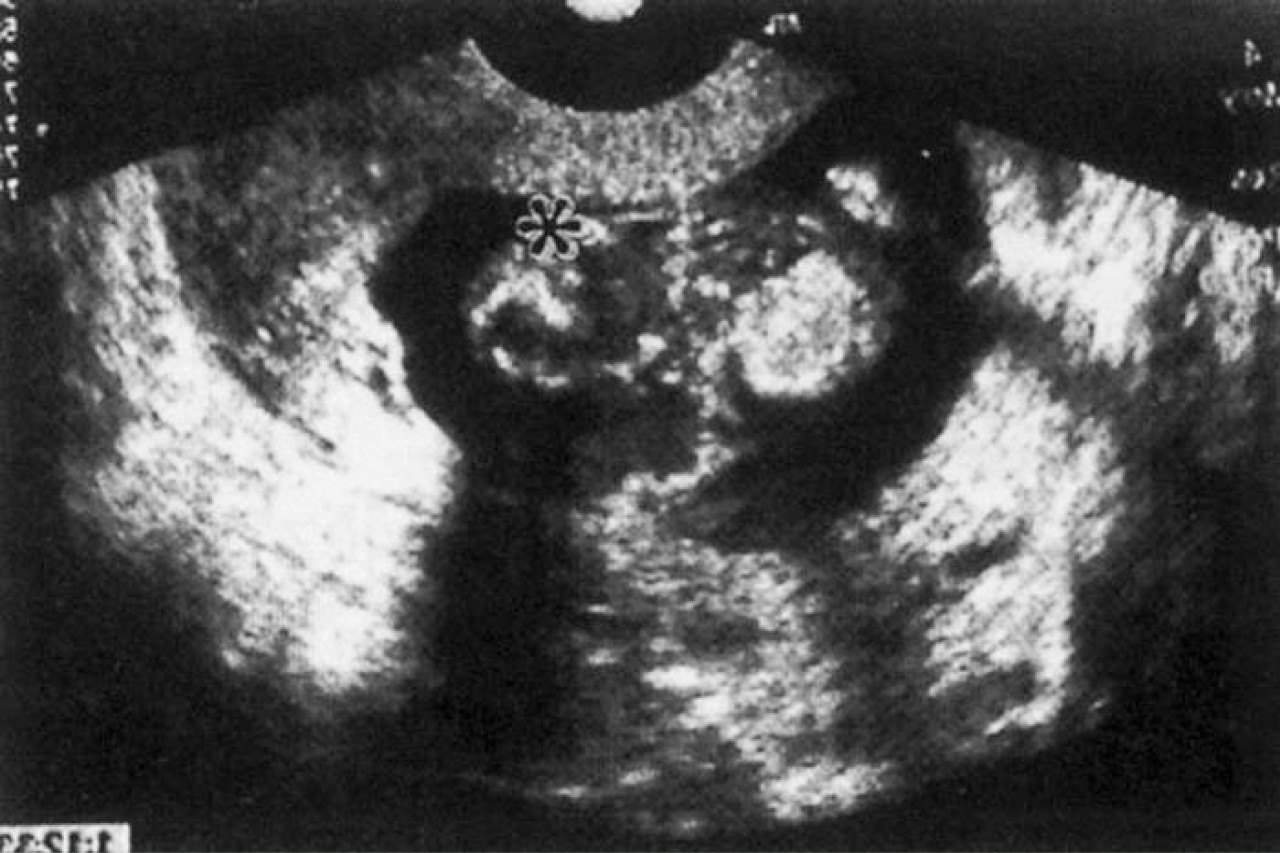 Manejo Prenatal de la Anencefalia - Diplomadomedico.com