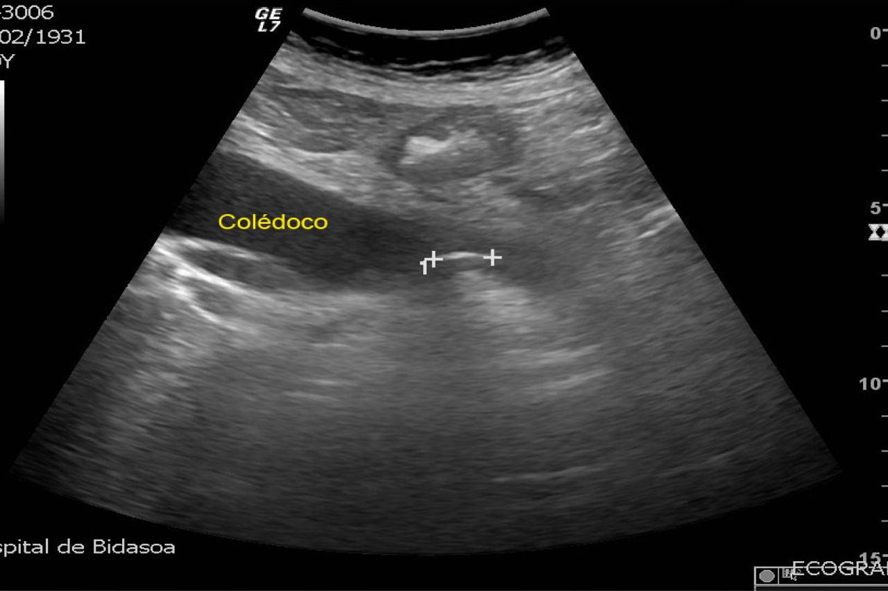 Factores predictivos para el diagnostico temprano de coledocolitiasis ...