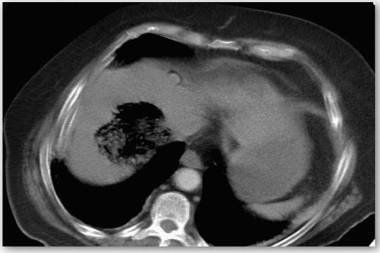 ABSCESO PIOGENOS HEPÁTICO - Diplomadomedico.com