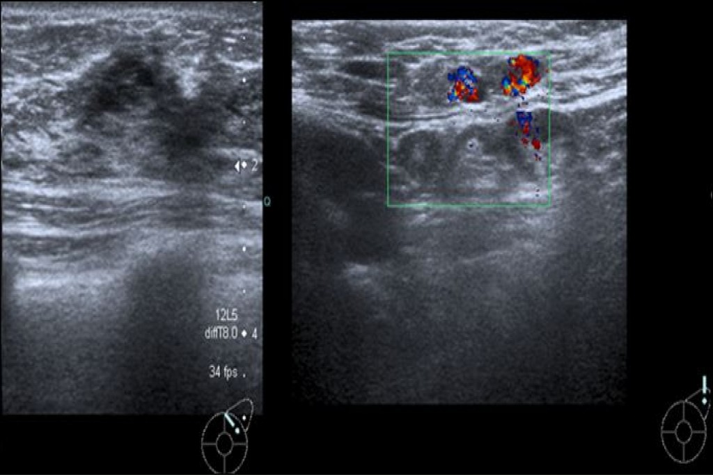 Mastitis granulomatosa idiopática - Diplomadomedico.com