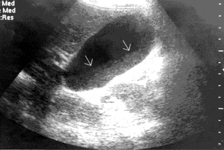 ENFERMEDAD LITIÁSICA BILIAR - Diplomadomedico.com