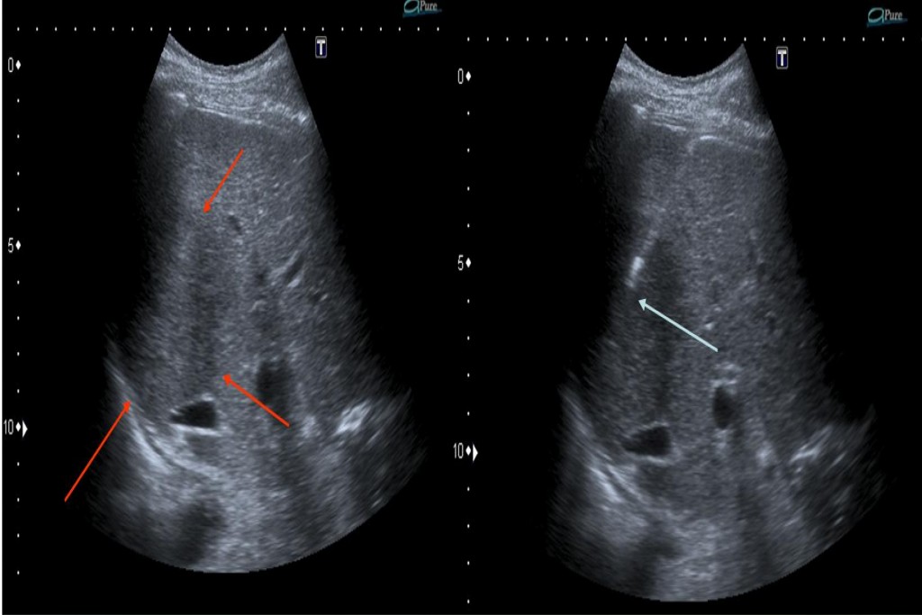 Drenaje percutáneo de absceso hepático guiado por ultrasonido abdominal ...