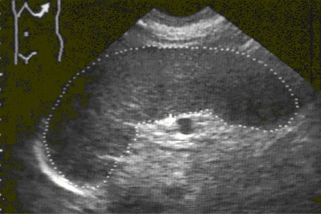 ESPLENOMEGALIA - Diplomadomedico.com