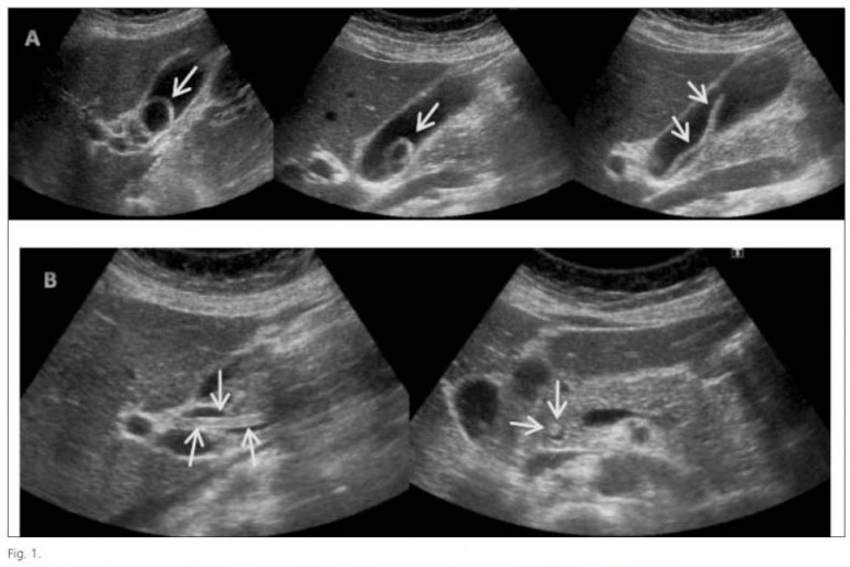 DIAGNOSTICO CLÍNICO Y EPIDEMIOLOGICO DE LA LITIASIS VESICULAR ...