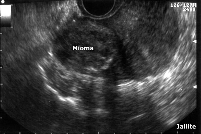 Miomas Em Imagens De Ultrassom Do Utero