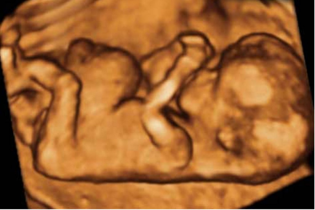 Diagnóstico prenatal de onfalocele mediante ultrasonografía ...