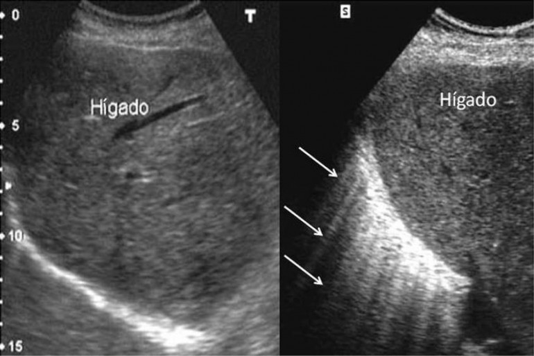 PROTOCOLO SONOGRAFICO DE EXPLORACIÓN DEL HÍGADO - Diplomadomedico.com