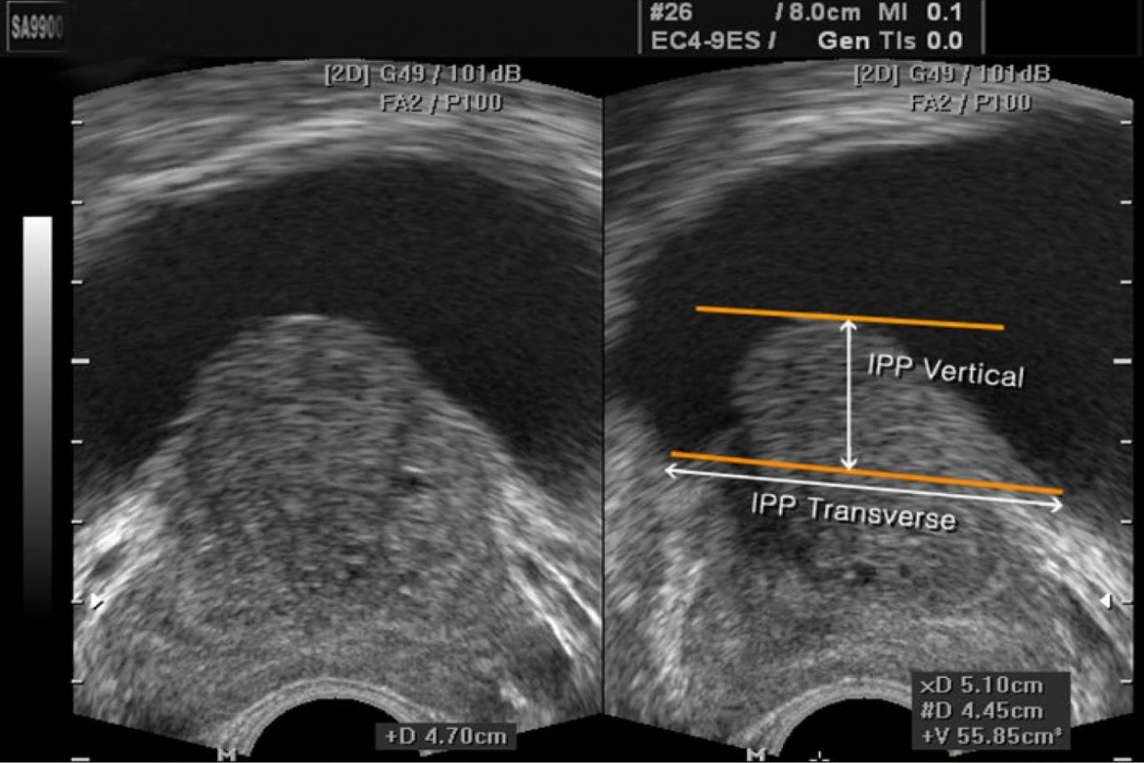 Diagnóstico y Tratamiento de la Hiperplasia prostática benigna mediante ...