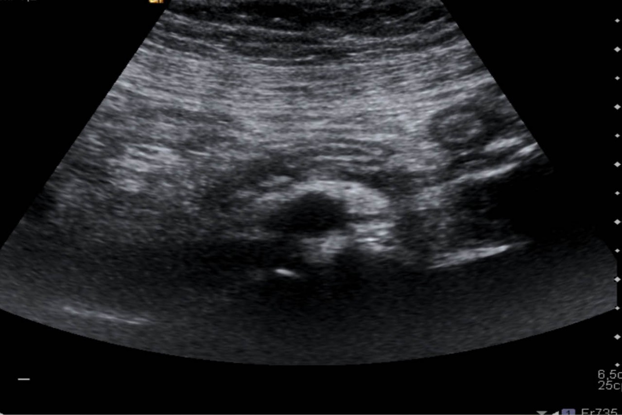 APENDICITIS DURANTE EL EMBARAZO - Diplomadomedico.com