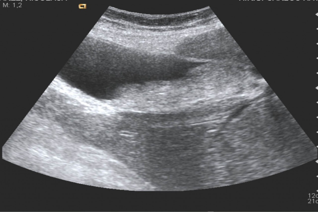 Enfermedad litiásica biliar - Diplomadomedico.com