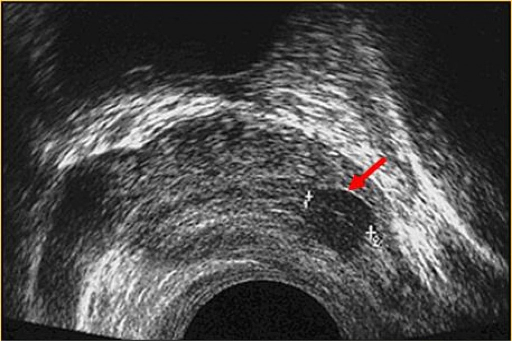 DETECCIÓN DE CÁNCER DE PRÓSTATA MEDIANTE BIOPSIA GUIADA POR ULTRASONIDO ...