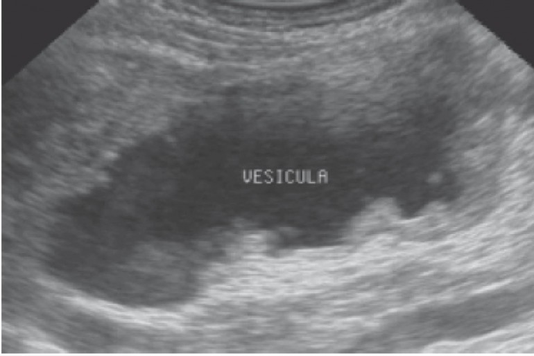 Abordaje diagnostico por imagen en patología benigna de la vesícula y ...
