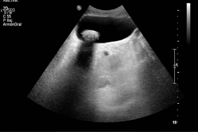 DIAGNOSTICO CLÍNICO Y EPIDEMIOLOGICO DE LA LITIASIS VESICULAR ...