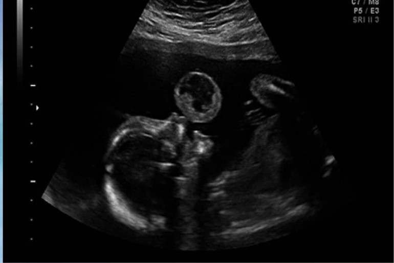 ESTUDIO ANÁTOMO-CLÍNICO DE LAS CAUSAS DE MUERTE FETAL - Diplomadomedico.com