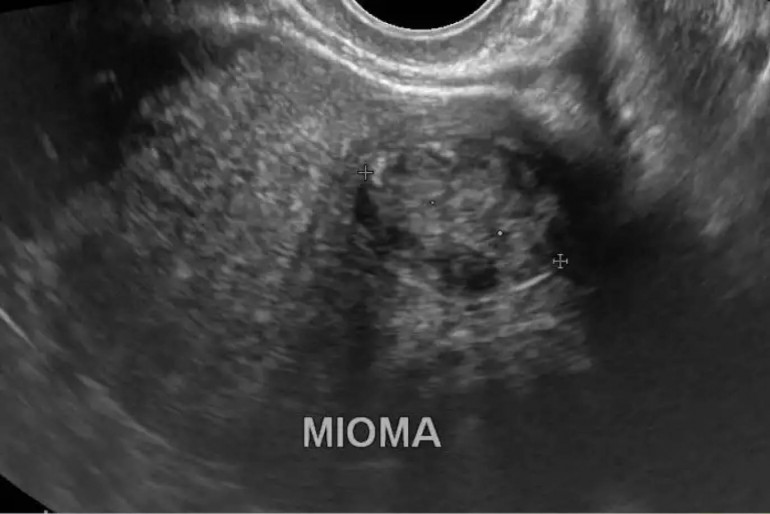 MIOMAS Y FUNCIÓN SEXUAL - Diplomadomedico.com