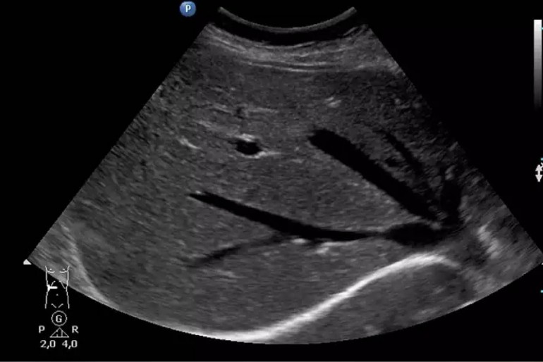 Hígado graso y esteatohepatitis no alcohólica.