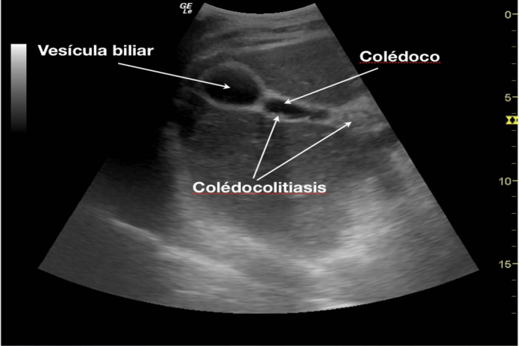 Dilema en el diagnóstico de quiste de colédoco - Ultrasonografía Médica