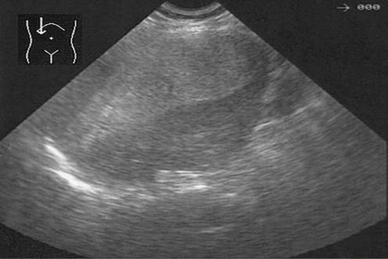 Ecografía Hepática - Ultrasonografía Médica