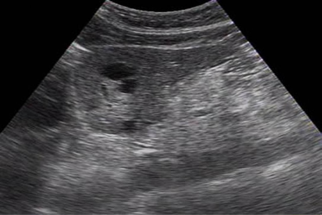 El Hígado - Ultrasonografía Médica