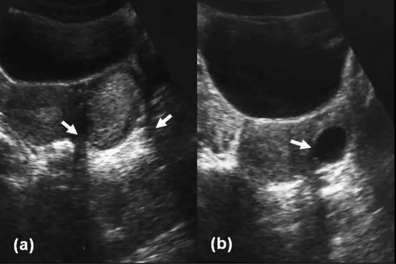 Tumores de ovario: patogenia, cuadro clínico, diagnóstico ecográfico e ...