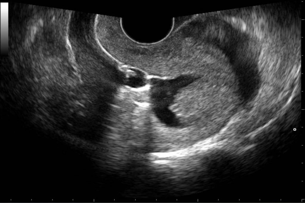 Comparación de la medición cervical y de la línea endometrial mediante ...