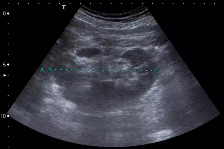 Ectopia renal simple