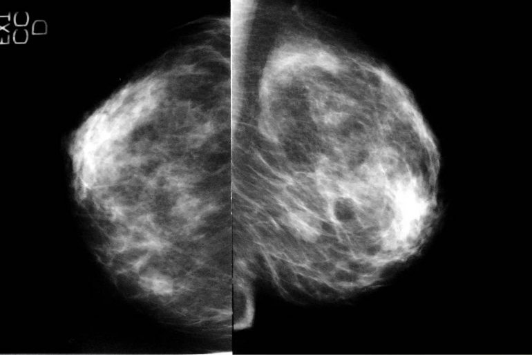 Sistema birads: descifrando el informe mamográfico