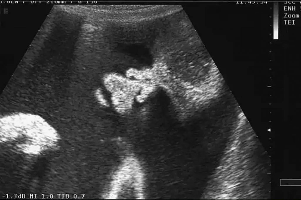 Diagnóstico prenatal de hidrops fetal no inmune - Ultrasonografía Médica