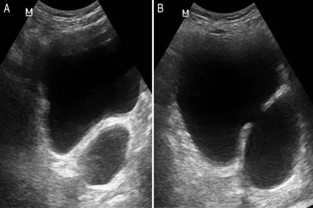 Hipertrofia prostática - Ultrasonografía Médica