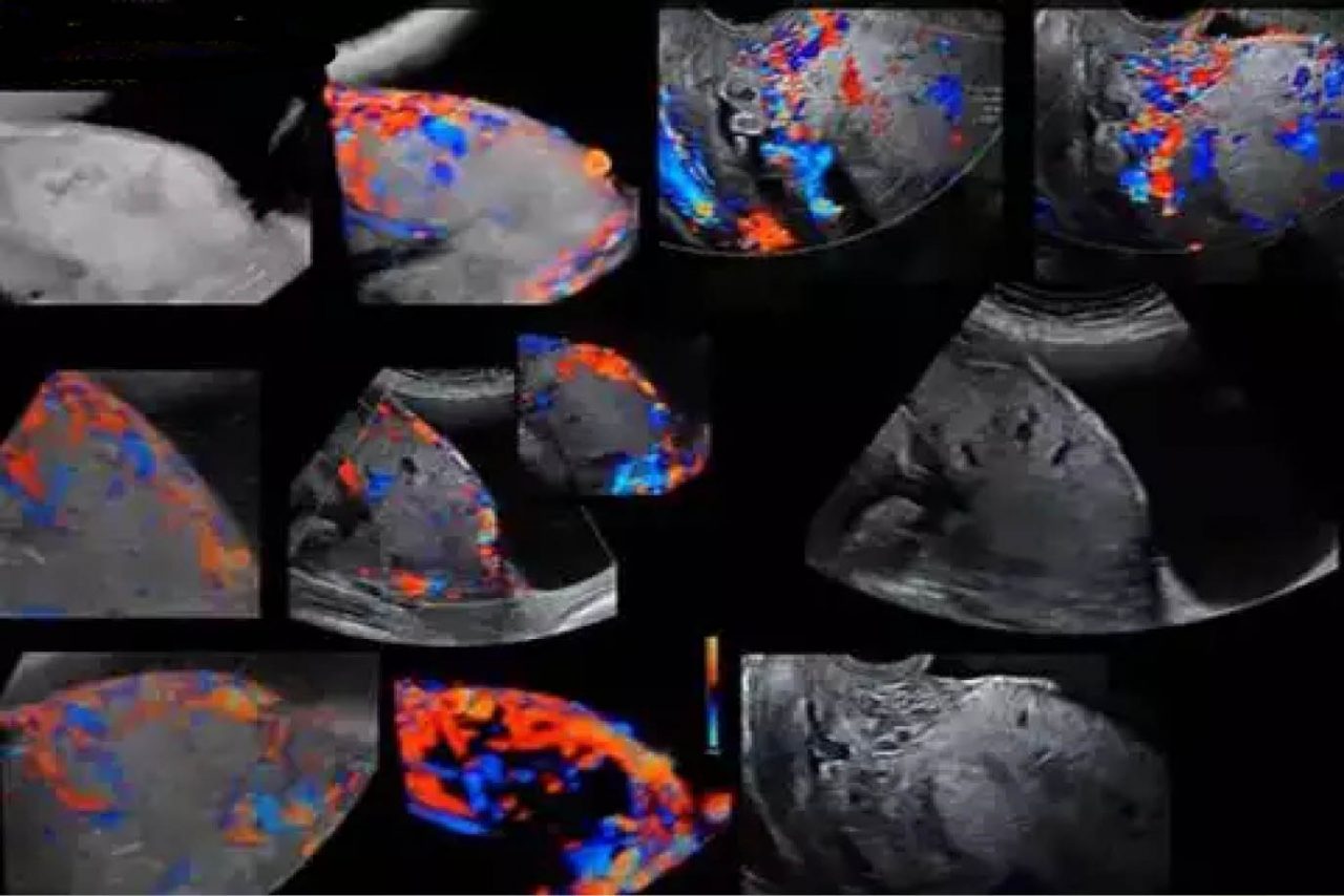 Acretismo placentario, un problema en aumento. El diagnóstico oportuno ...