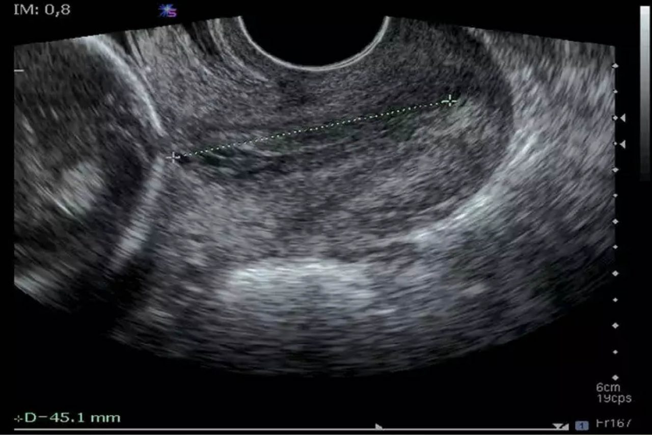 Comparación de la medición cervical y de la línea endometrial mediante ...
