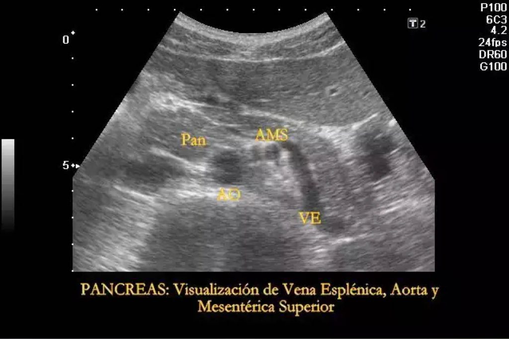 Referencias anatómicas del páncreas - Ultrasonografía Médica
