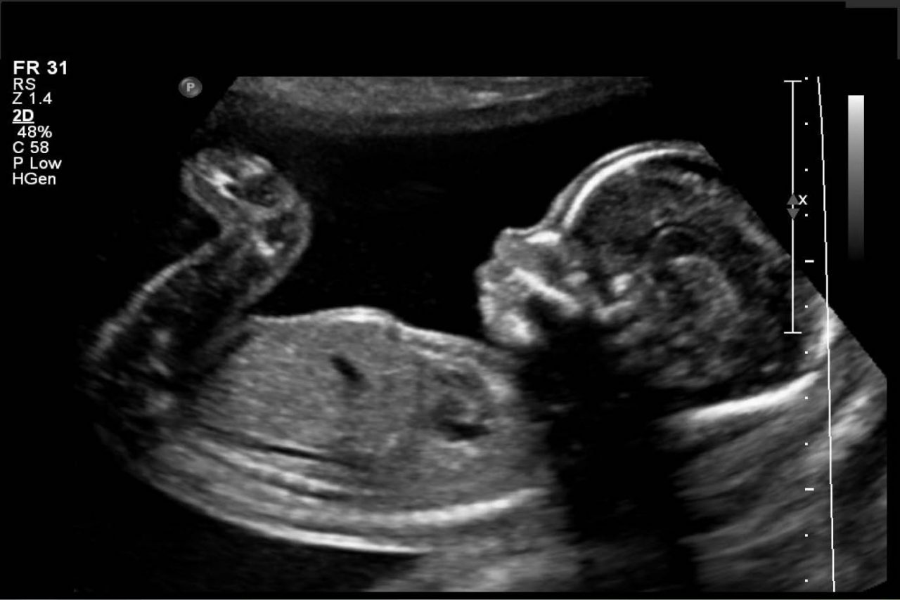 Perfil biofísico para conocer el bienestar fetal - Ultrasonografía Médica