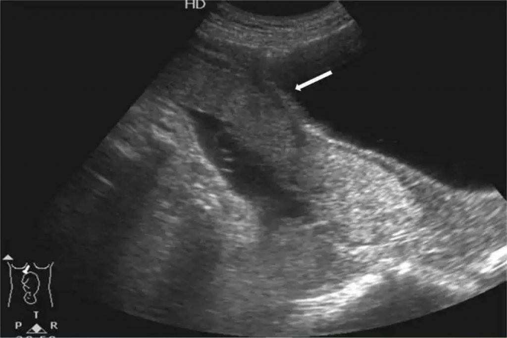 Componentes anatómicos de la placenta - Ultrasonografía Médica