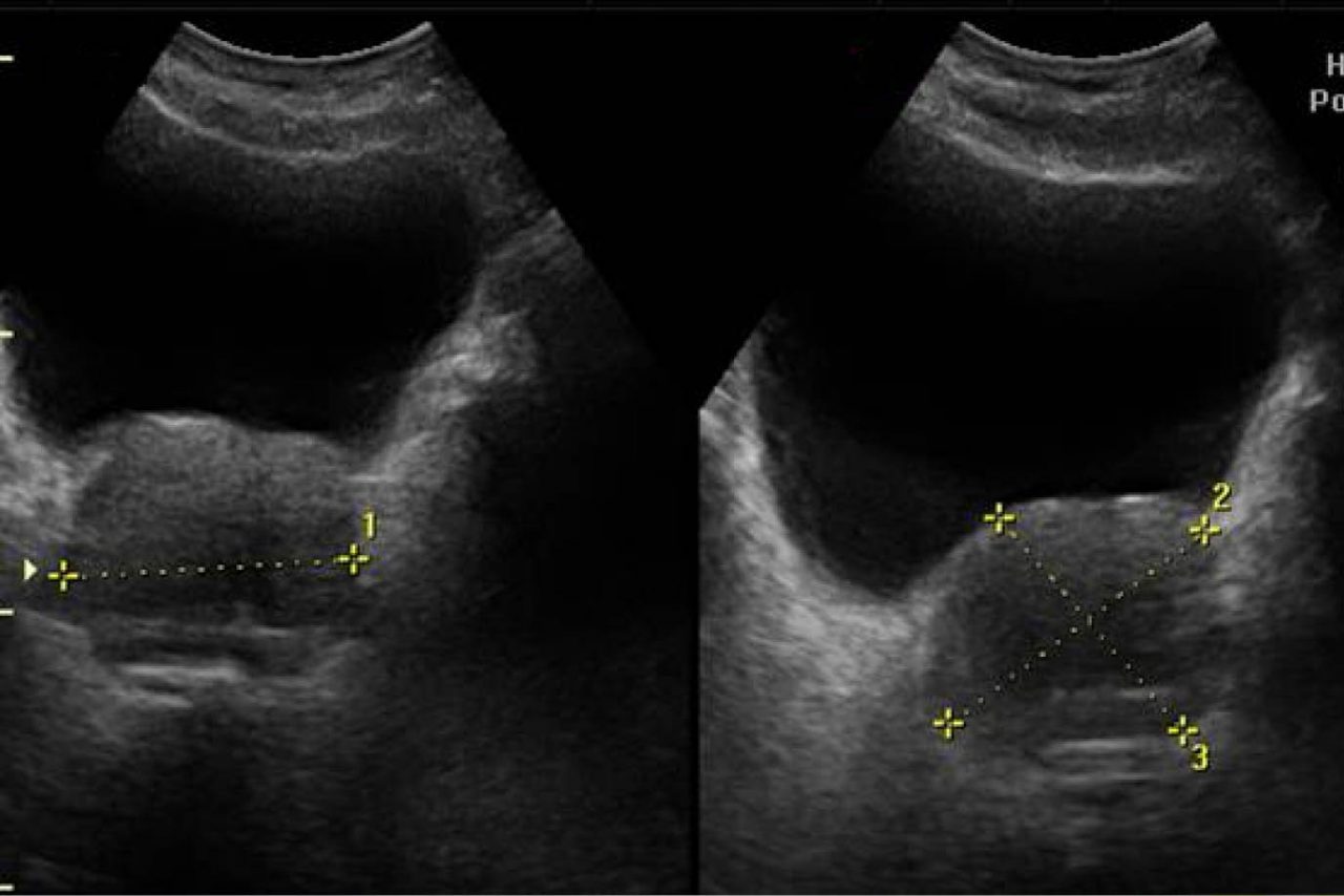 Diagnóstico y seguimiento de la hipertrofia prostática benigna mediante ...