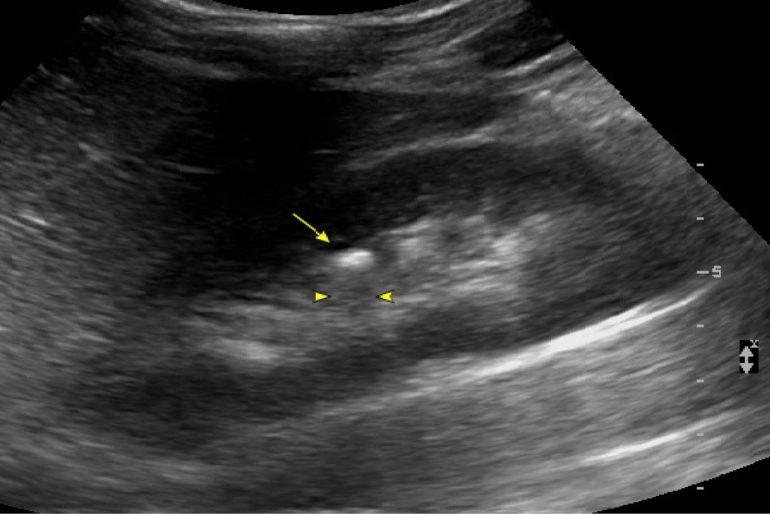 Calcificaciones renales: imagen en ecografía