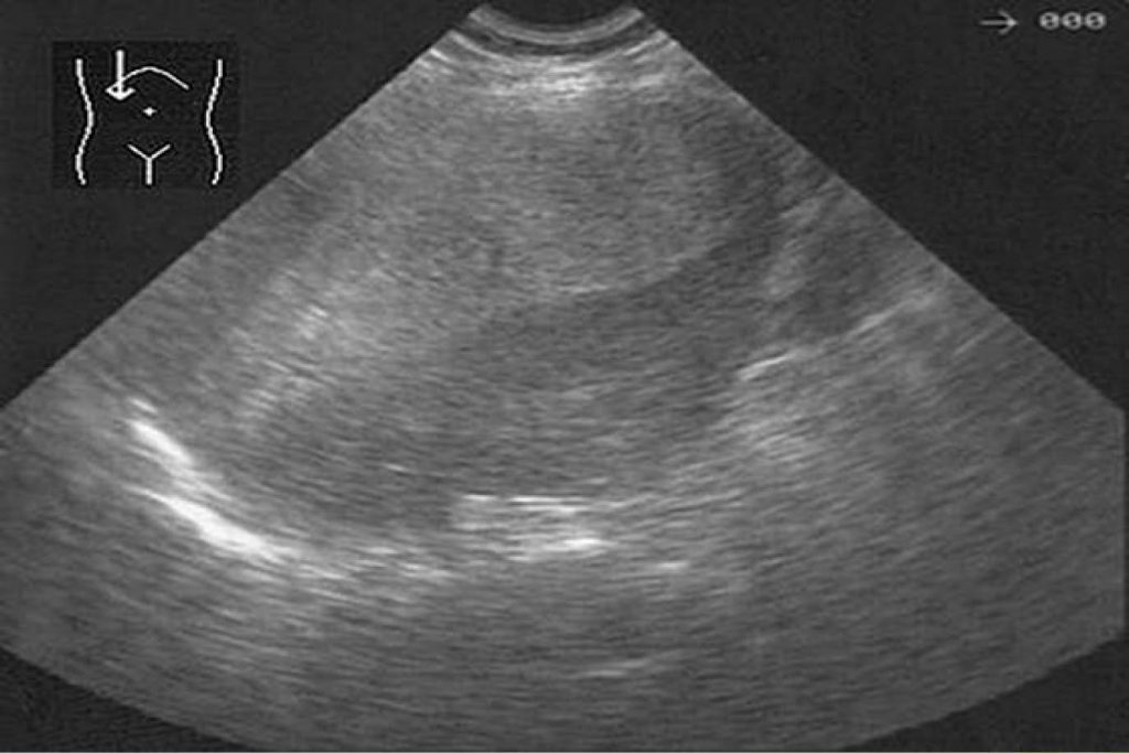 Protocolo de exploración del hígado