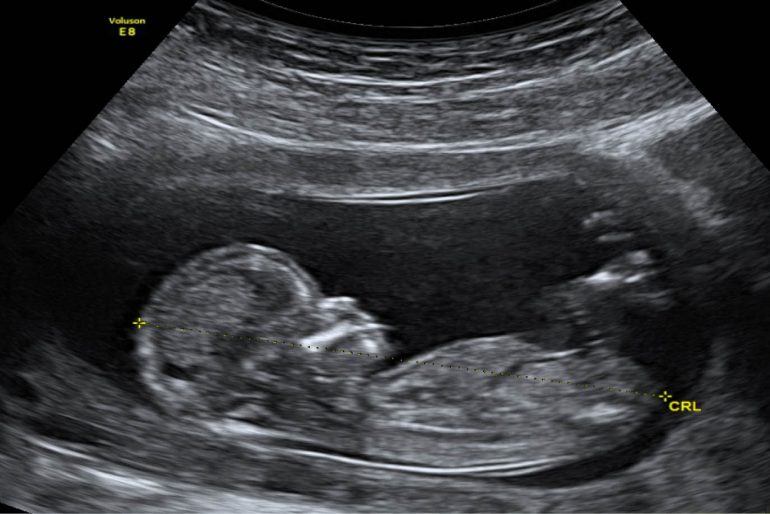 Estudio anátomo-clínico de las causas de muerte fetal