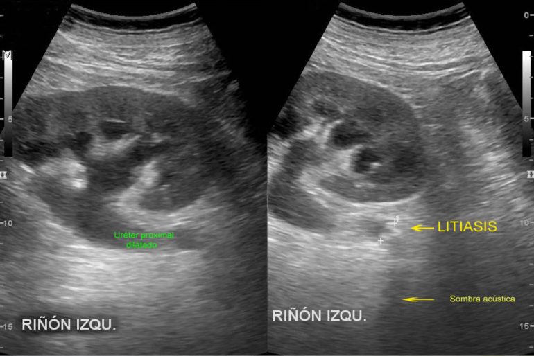 Litiasis renal Modificaciones bioquímicas durante el seguimiento